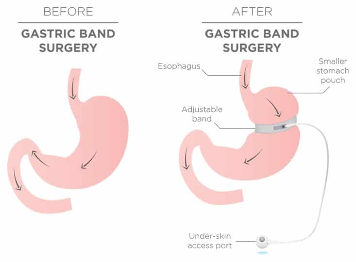 Lap Band Surgery Sydney - Laparoscopic Adjustable Gastric Banding