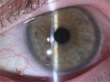 Corneal Transplant Surgery Austin TX – DSEK & DMEK | Austin Eye