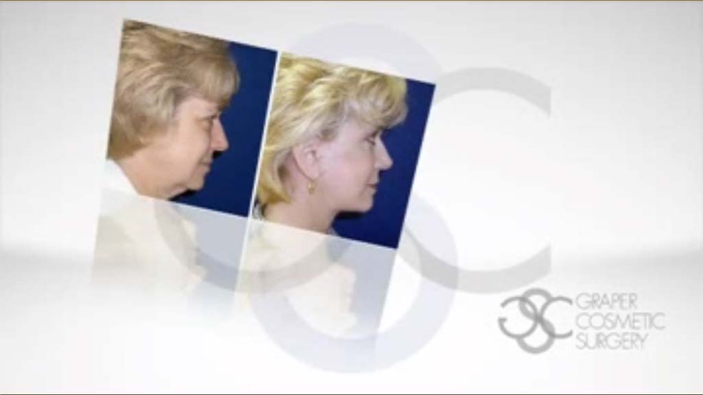 Videos - Graper Harper Cosmetic Surgery