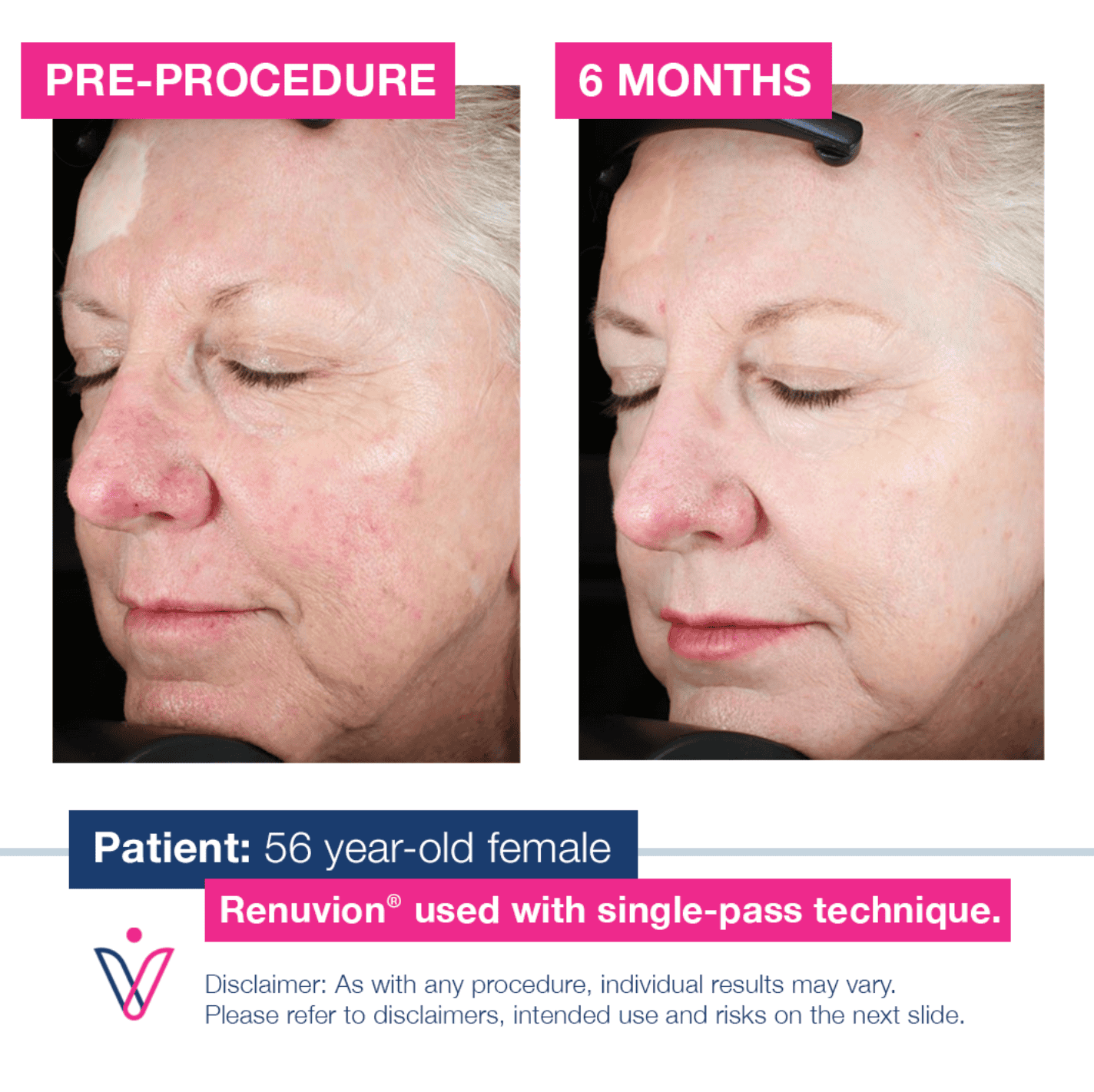 Skin Renuvion Charlotte NC - Skin Tightening Charlotte NC