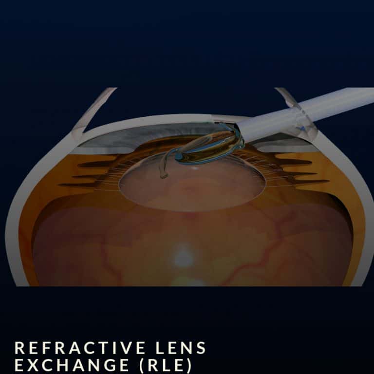 Conditions Los Angeles - Expert Eye Care Orange County