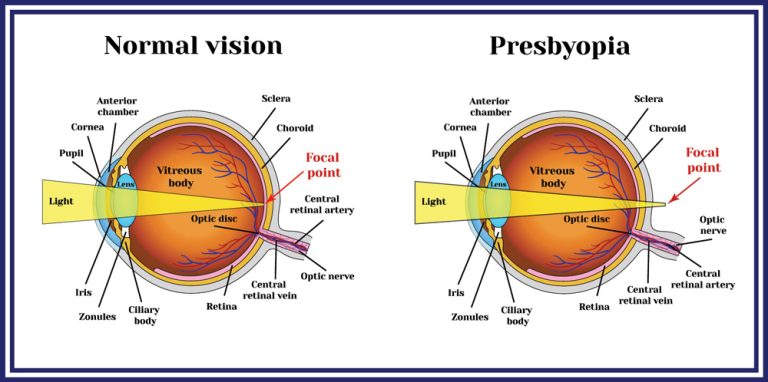LASIK Alternatives Los Angeles - PRK Eye Surgery Los Angeles