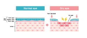 2025 New Dry Eye Treatments LA - iLux²® - BlephEx® - IPL
