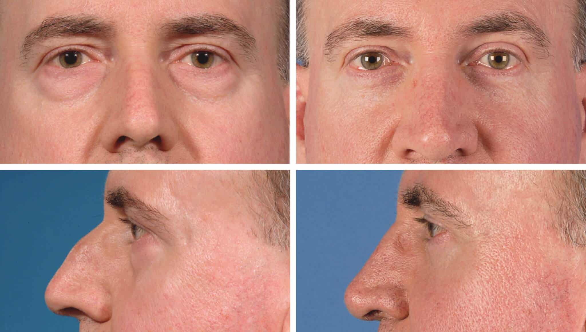 The Five-Step Lower Blepharoplasty: Blending the Eyelid-Cheek Junction ...