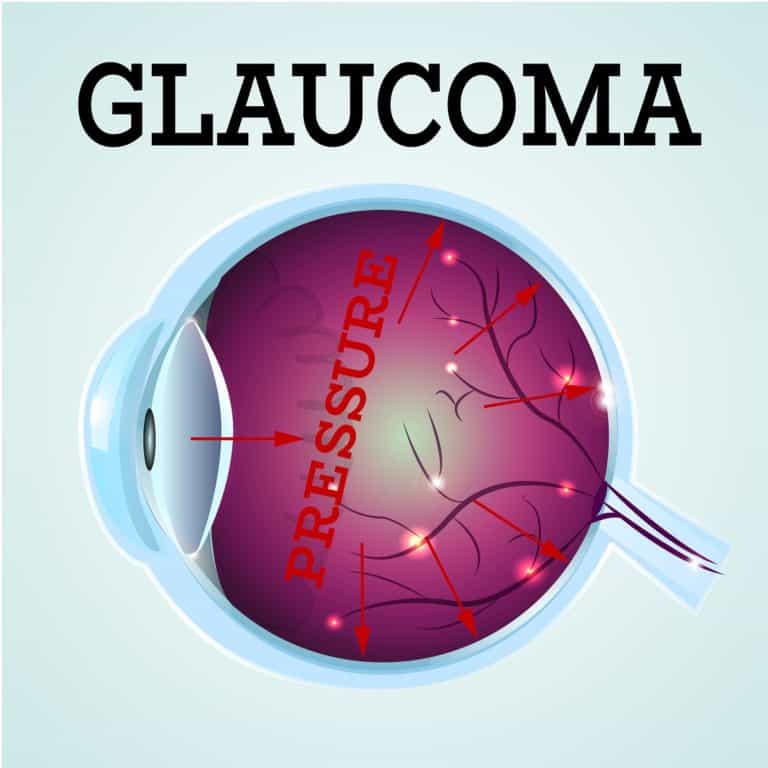 Glaucoma: The Importance of Early Detection | Scottsdale & Glendale