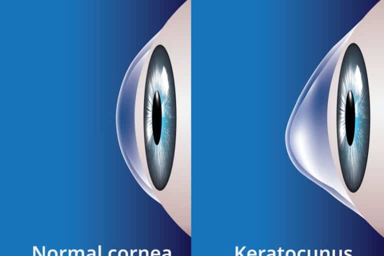 Corneal Crosslinking Can Slow the Progression of Keratoconus in Mesa