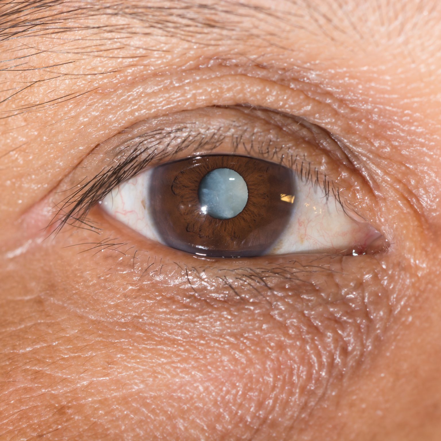 What is it like to go through cataract surgery? - Solinsky EyeCare