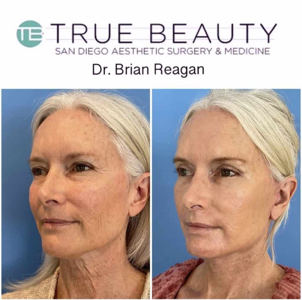 Facial Rejuvenation Procedures, Youthful Complexion, San Diego